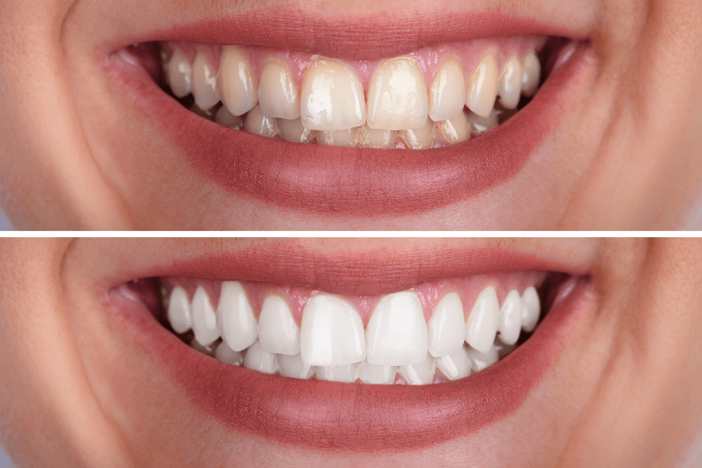 At Home Teeth Whitening In Spring League City Cypress TX